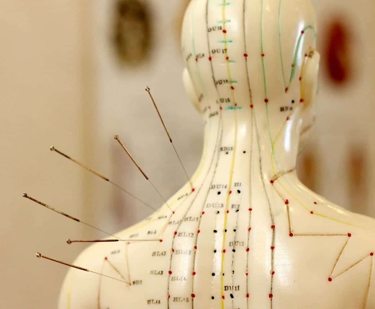 Acupuncture for Everyday Pain | Physio Connect